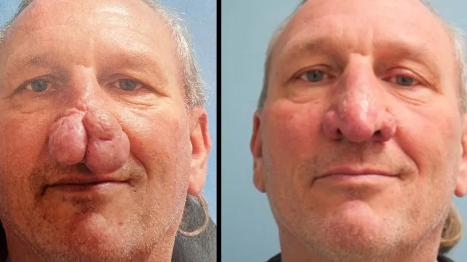 Litt unter Rhinophym: Neue Nase veränderte sein Leben - oe24.at